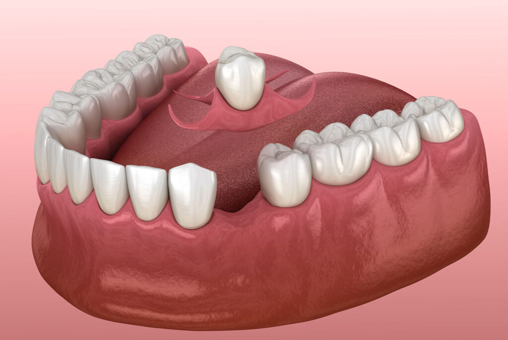 Full & Partial Dentures Brandon FL | Brandon Complete Dental Care